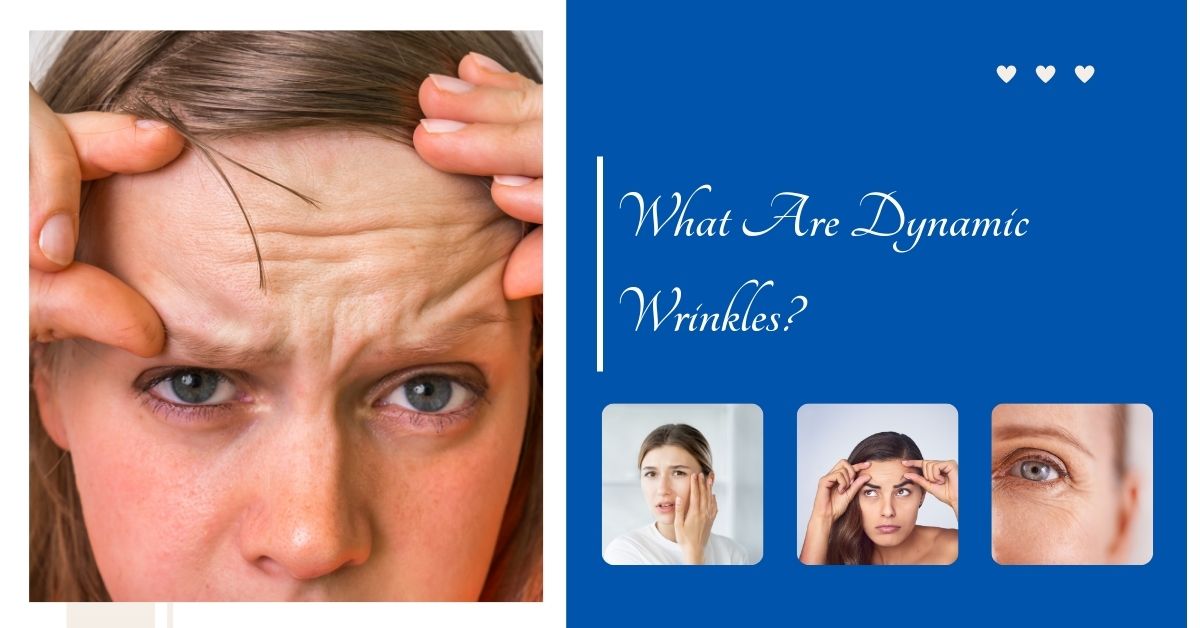 Botox for Dynamic Wrinkles-Diamond Aesthetics